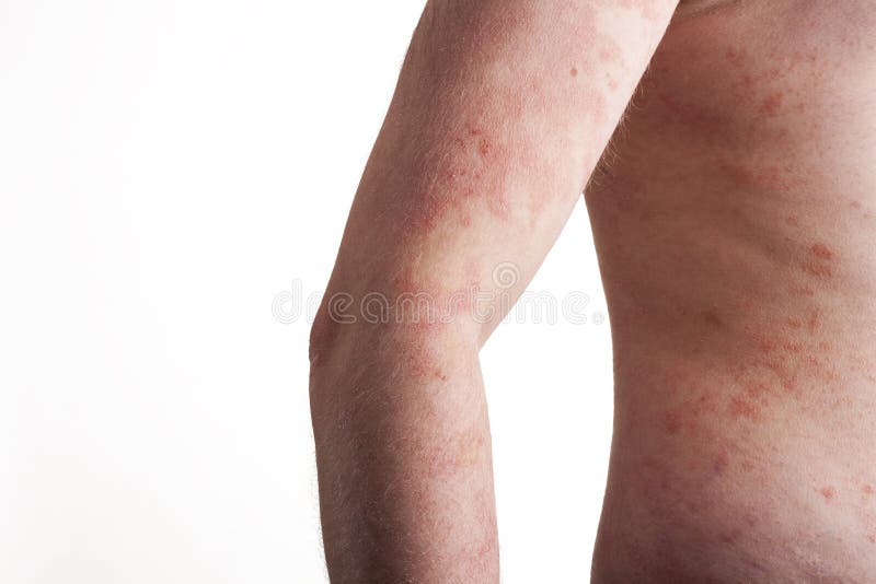 Psoriasis sur le bras photo stock. Image of écaillement - 40723078