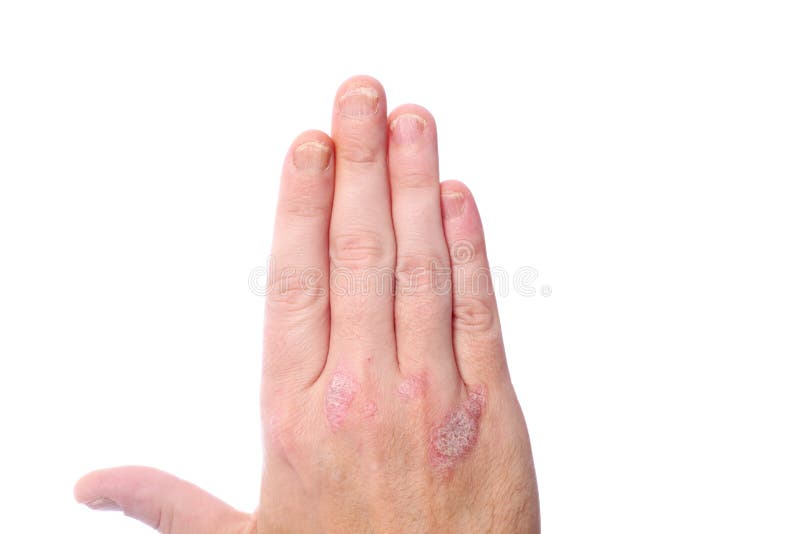 Psoriasis Sur Les Mains Et Les Ongles Image stock - Image du blanc ...