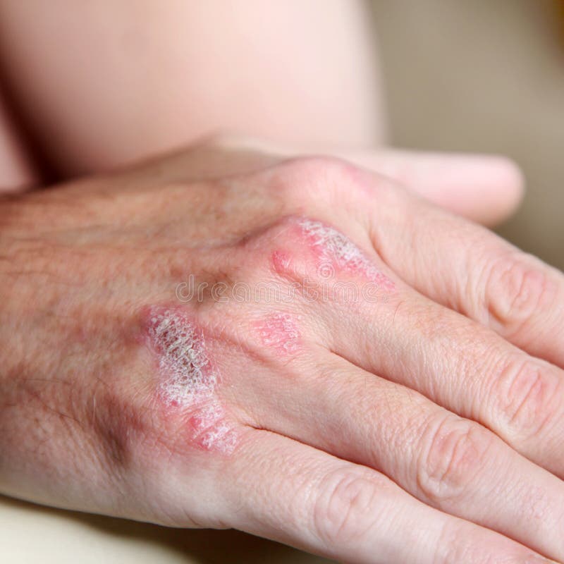 Un Patient Atteint De Psoriasis Se Gratte Les Mains Déchirure Cutanée ...