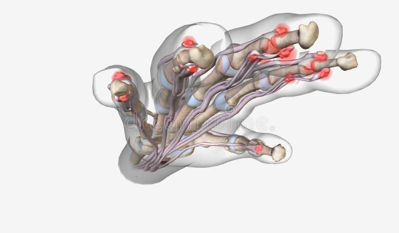 Psoriatic Arthritis Effects on Hand Joints Stock Illustration ...