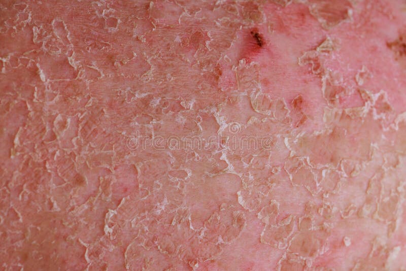 Psoriatic Eczema is a Complex Skin Disease that Demands ...