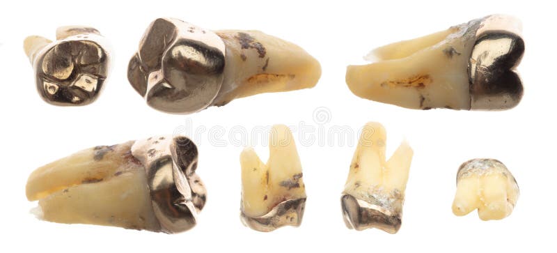 Pulled Molar Tooth with Gold Crown To Show Many Angle, Advanced Caries ...