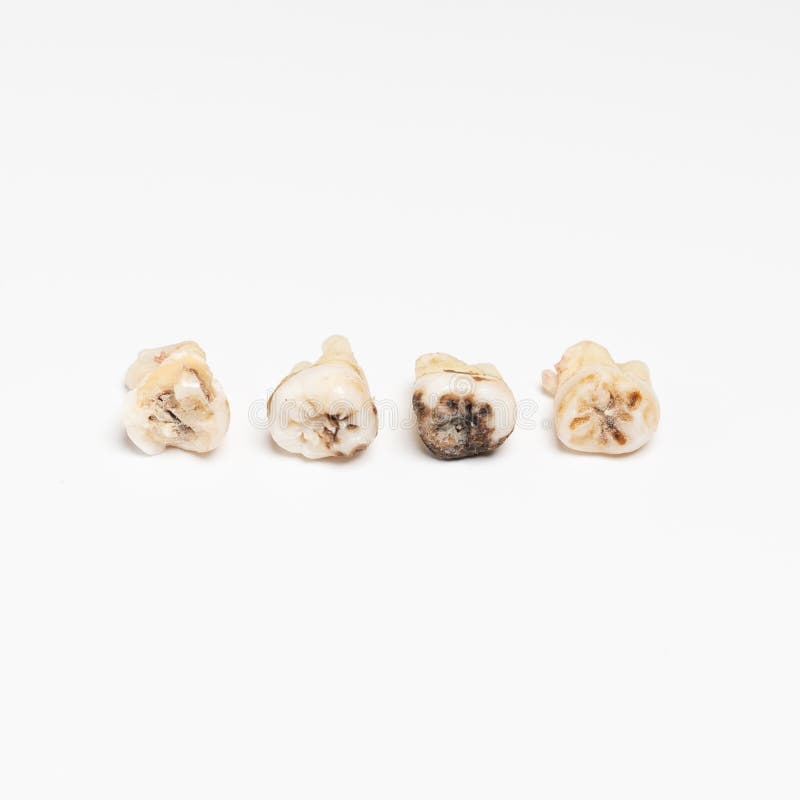 Pulled Out Bad Molars Human Teeth Close Up on White Background Stock ...