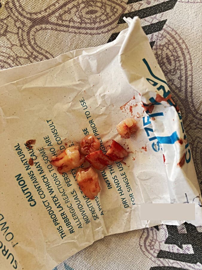 Pulled Out a Bad Tooth in the Forceps of the Dentist Stock Image ...