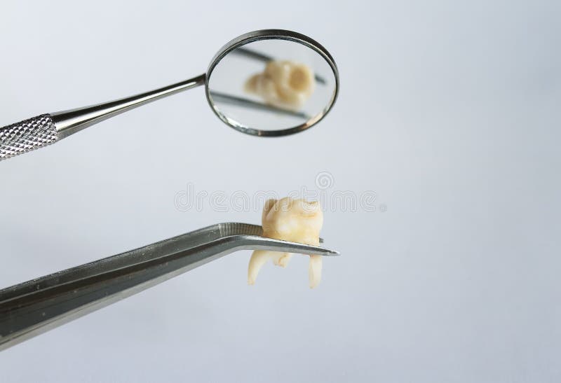 Pulled Molar Tooth with Gold Crown To Show Many Angle, Advanced Caries ...