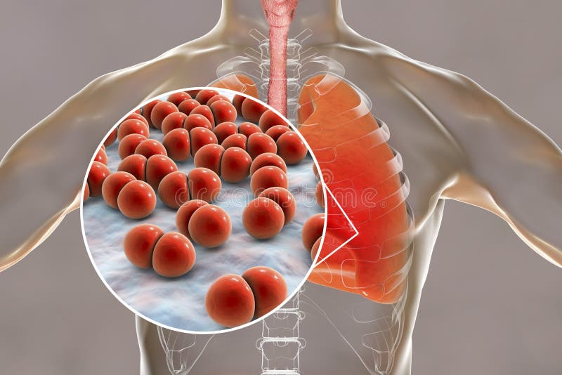 Pulmonía Neumocócica, Concepto Médico Stock de ilustración ...