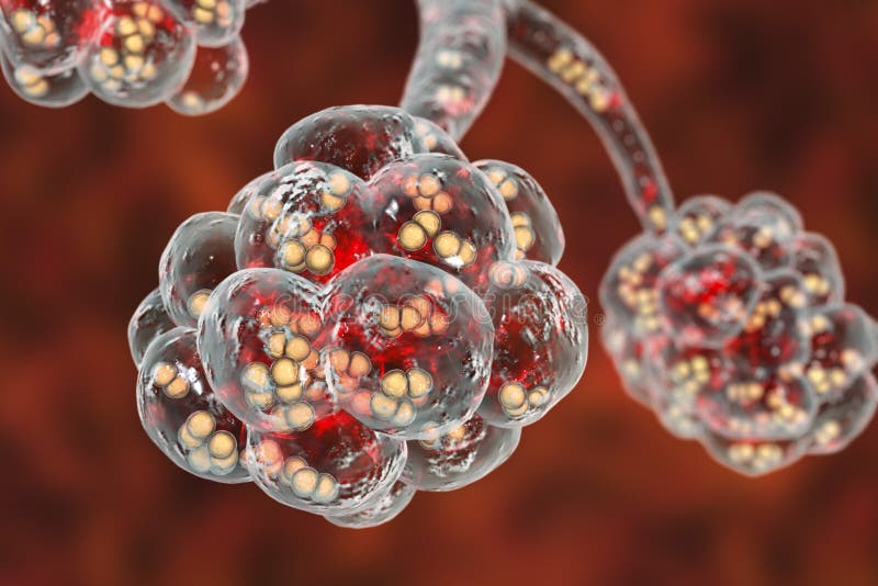 Pulmonía Neumocócica, Concepto Médico Stock de ilustración ...