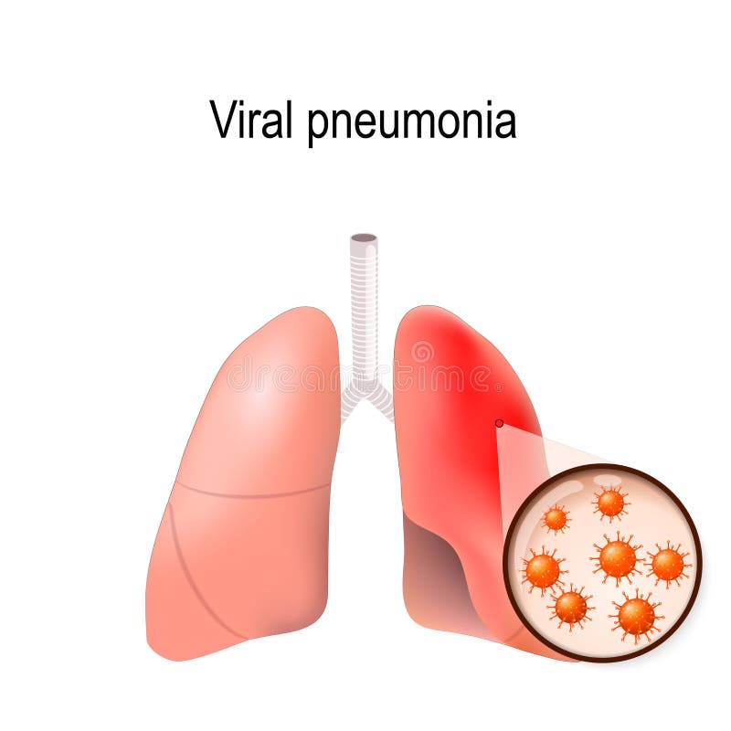 Pulmonía - Condición Inflamatoria De Los Pulmones - Anatomía Stock de ...