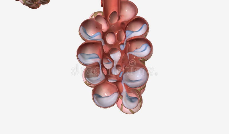 Pulmonary Edema is a Condition Caused by Too Much Fluid in the Lungs ...