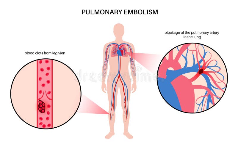 Pulmonary Embolism Diagram