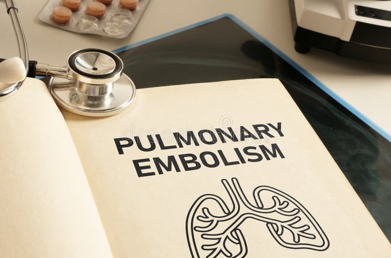Pulmonary Embolism is Shown Using the Text Stock Photo - Image of ...