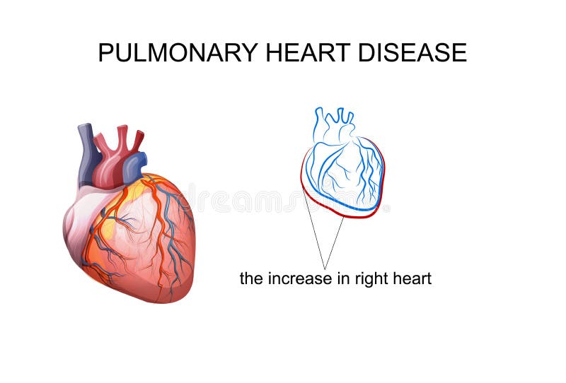 Pulmonary hypertension stock vector. Illustration of chest - 19629414