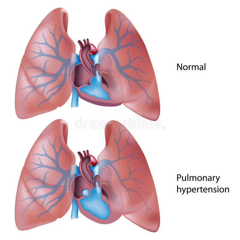 Pulmonary hypertension stock vector. Illustration of chest - 19629414