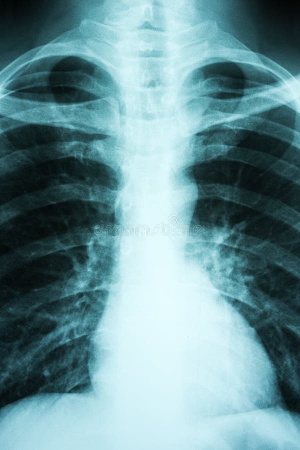 Pulmonary X-Ray stock photo. Image of diagnostic, health - 46349650