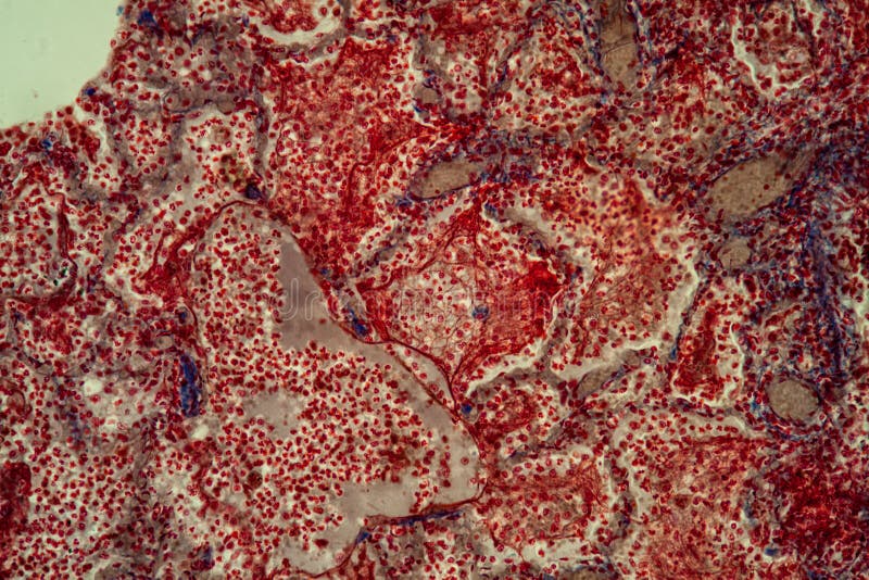 Pulmonary Tuberculosis Tissue 200x Stock Photo - Image of tuberculosis ...