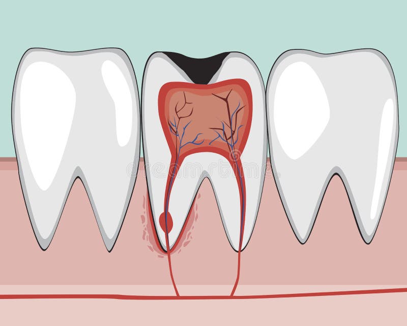 A Pulpitis of a Molar or Periodontitis of the Tooth with Inflammation ...