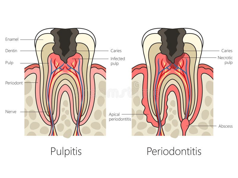 Pulpitis and Periodontitis Diagram Medical Science Stock Vector ...