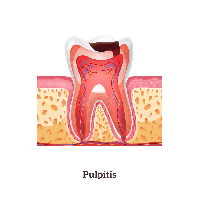 Pulpitis and Healthy tooth stock vector. Illustration of deep - 56416784