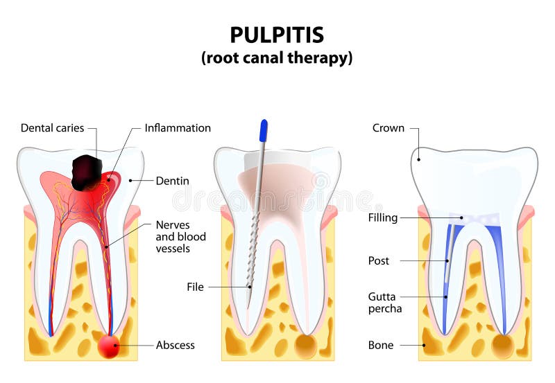 Pulpitis stock vector. Image of disease, caries, canal - 68836731