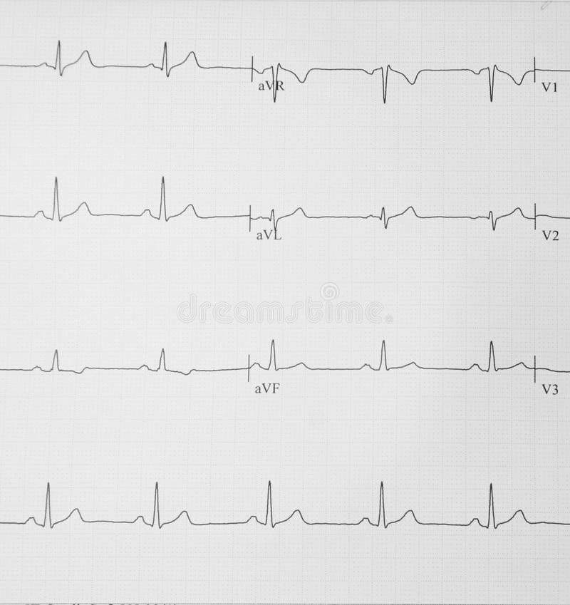 Pulse trace stock image. Image of electrocardiogram, electrical - 4298641