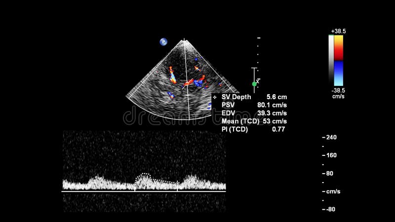 Pulse Wave Doppler Ultrasound Examination. Stock Image - Image of ...