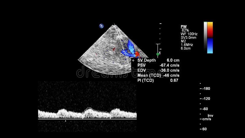 Pulse Wave Doppler Ultrasound Examination. Stock Image - Image of ...