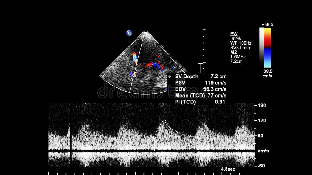 Pulse Wave Doppler Ultrasound Examination. Stock Image - Image of ...