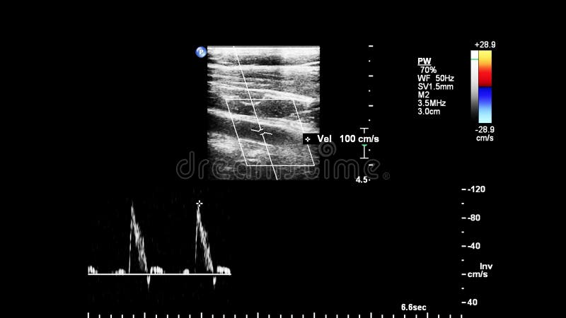 Pulse Wave Doppler Ultrasound Examination. Stock Image - Image of ...