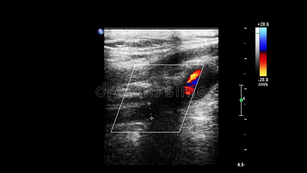 Pulse Wave Doppler Ultrasound Examination. Stock Image - Image of ...
