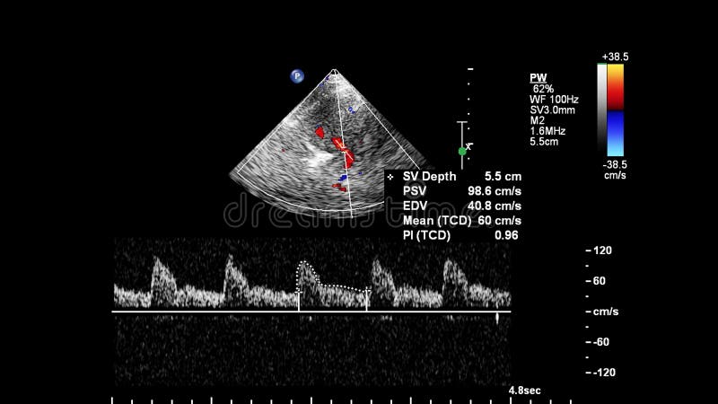 Pulse Wave Doppler Ultrasound Examination. Stock Image - Image of ...