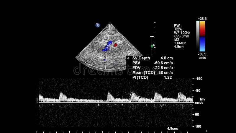 Pulse Wave Doppler Ultrasound Examination. Stock Photo - Image of ...