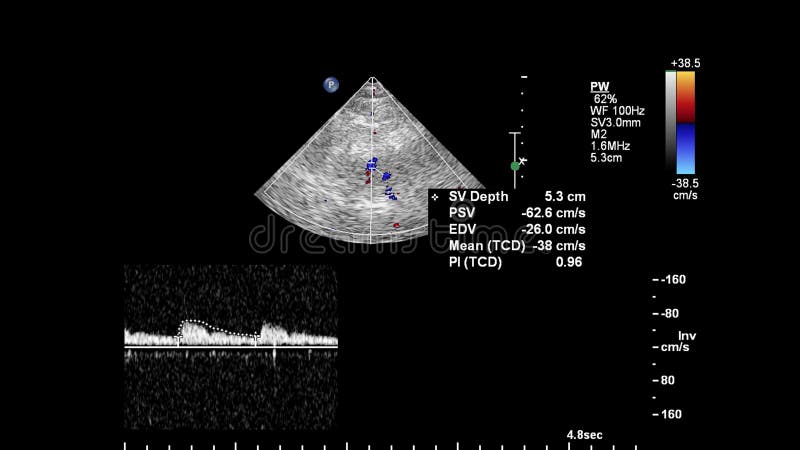 Pulse Wave Doppler Ultrasound Examination. Stock Photo - Image of hand ...