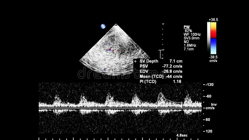 Pulse Wave Doppler Ultrasound Examination. Stock Photo - Image of ...