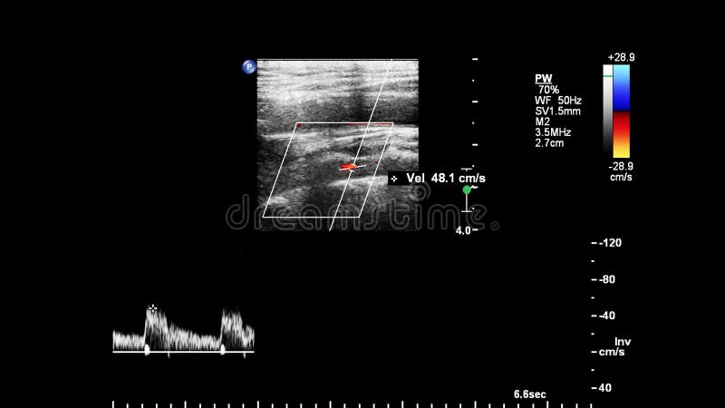Pulse Wave Doppler Ultrasound Examination. Stock Image - Image of ...