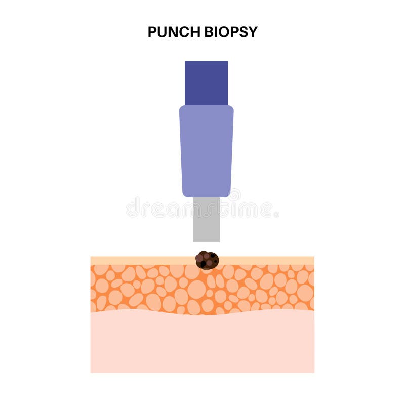 Punch Biopsy Procedure Stock Vector Illustration Of Melanoma 274593974