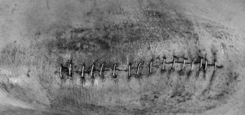 Herida Y Puntadas En El Antebrazo Imagen de archivo - Imagen de corte ...