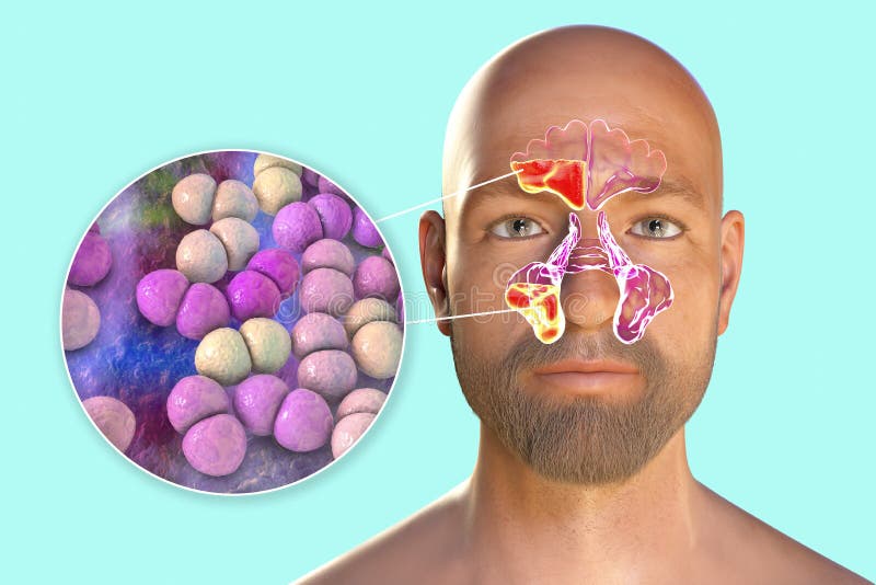 Purulent Inflammation of Frontal and Maxillary Sinuses and Close-up ...