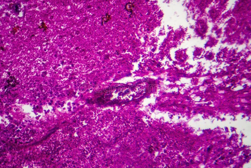 Purulent Meningitis, Light Micrograph Stock Image - Image of meningitis ...