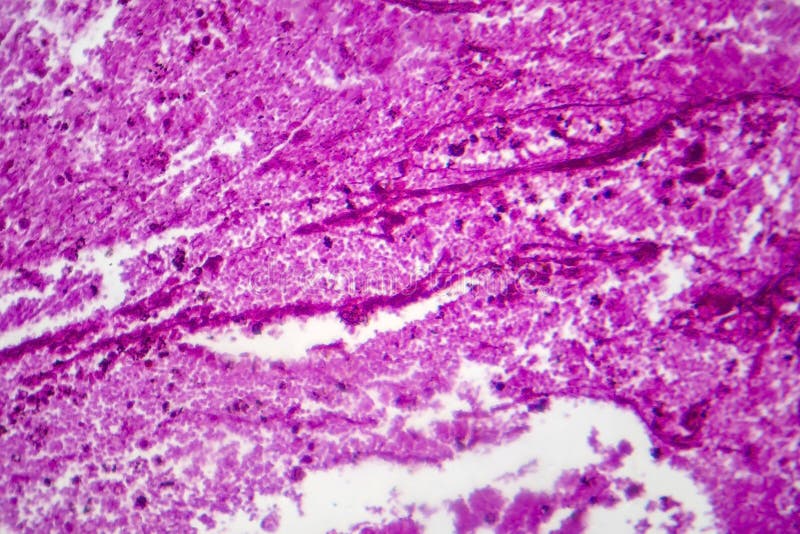 Purulent Meningitis, Light Micrograph Stock Image - Image of ...