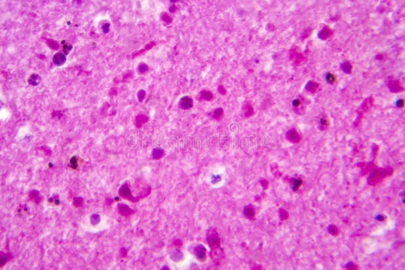 Purulent Meningitis, Light Micrograph Stock Photo - Image of ...