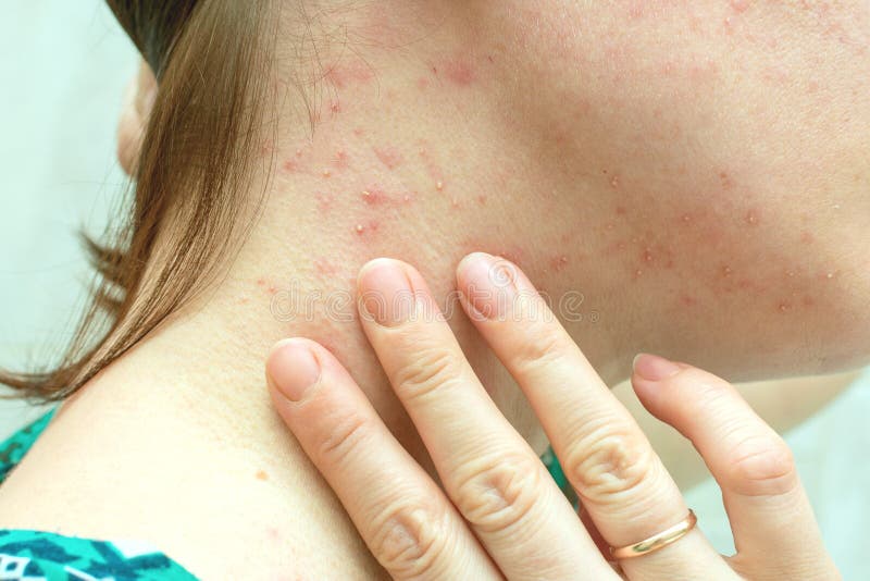 Purulent Rashes on the Neck of Woman. Allergy, Acne Stock Image - Image ... Purulent Rashes on the Neck of Woman. Allergy, Acne Stock Image - Image ...