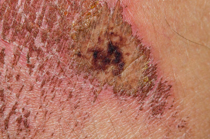 Purulent Wound on the Skin of the Human Body Stock Photo - Image of ...