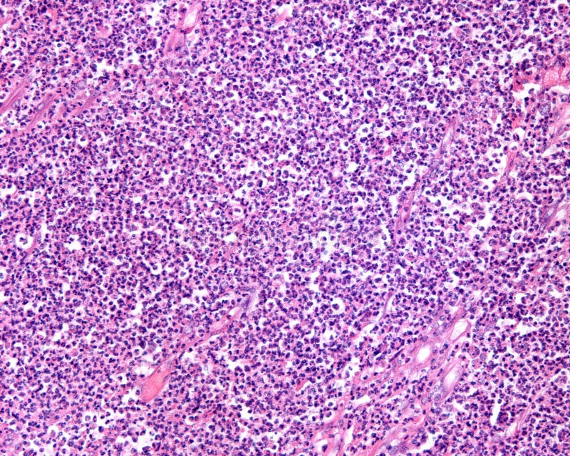 Pus stock image. Image of medicine, blood, micrograph - 250322267