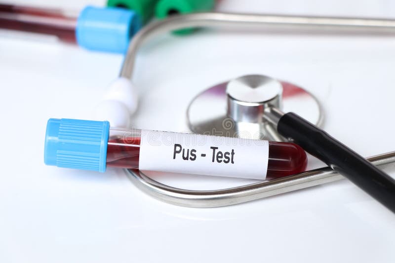 Pus Test, Blood Sample To Analyze in the Laboratory Stock Image - Image ...