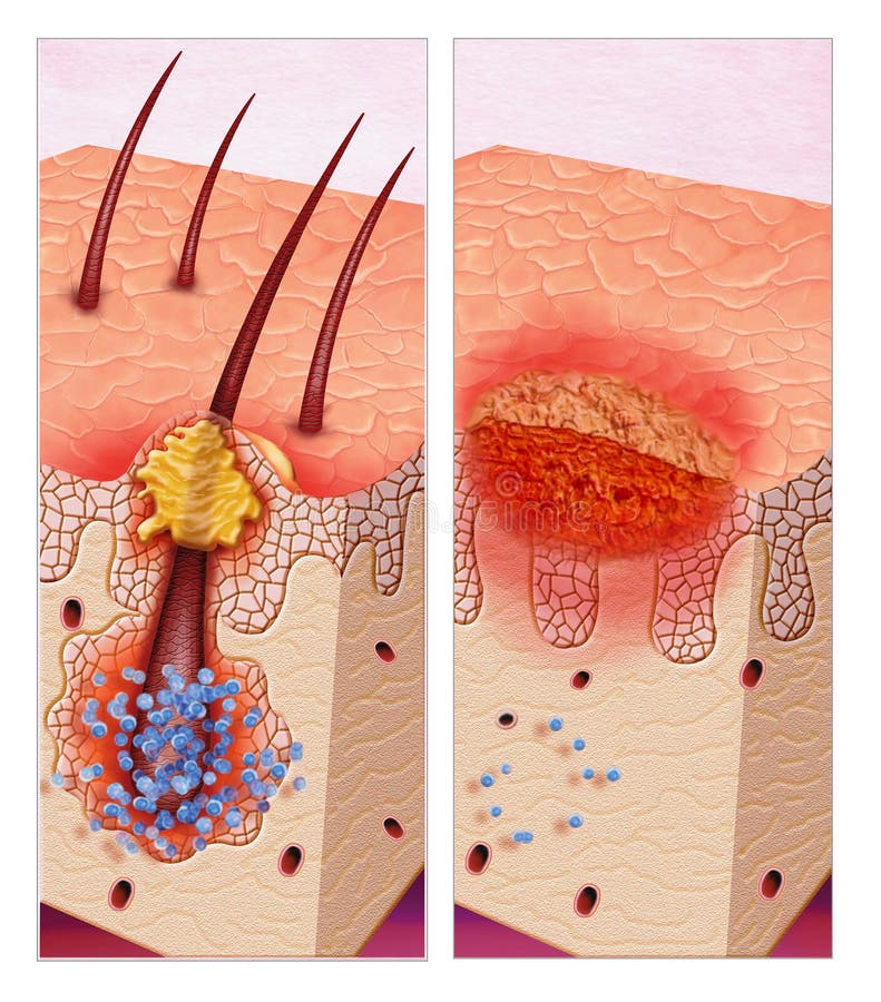 Pustula oder Folliculitis stock abbildung. Illustration von haar - 95274582
