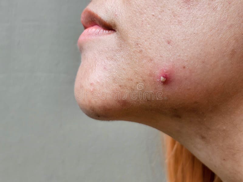 Pustular Acne Stock Photos - Free & Royalty-Free Stock Photos from ...