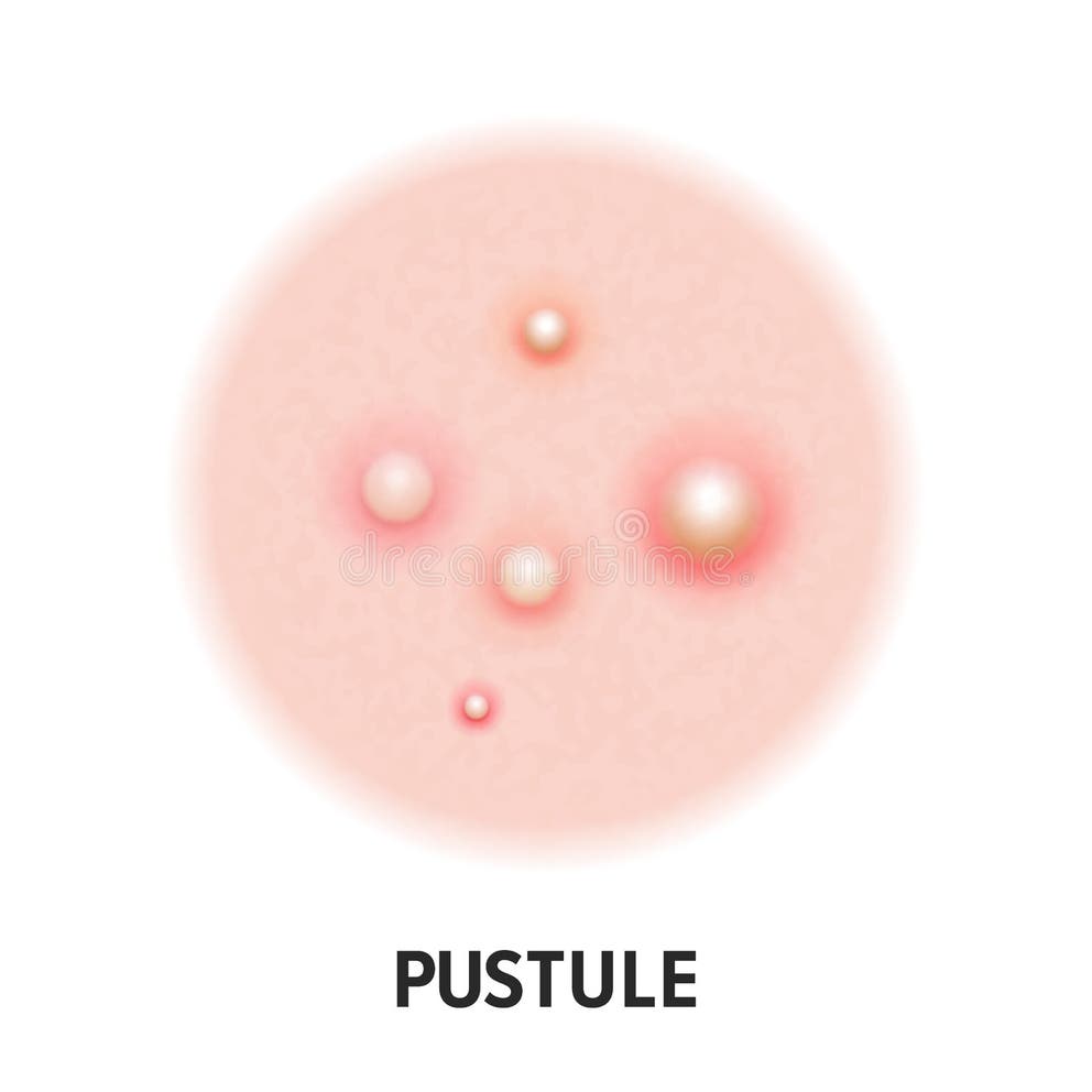 Acne Type Stock Illustrations 685 Acne Type Stock Illustrations