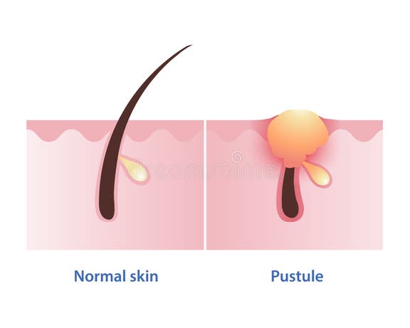 Papule Vector Stock Illustrations – 1,075 Papule Vector Stock ...