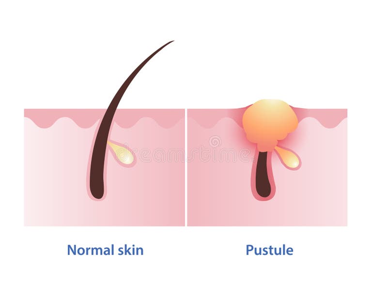 Papule Vector Stock Illustrations 1 075 Papule Vector Stock