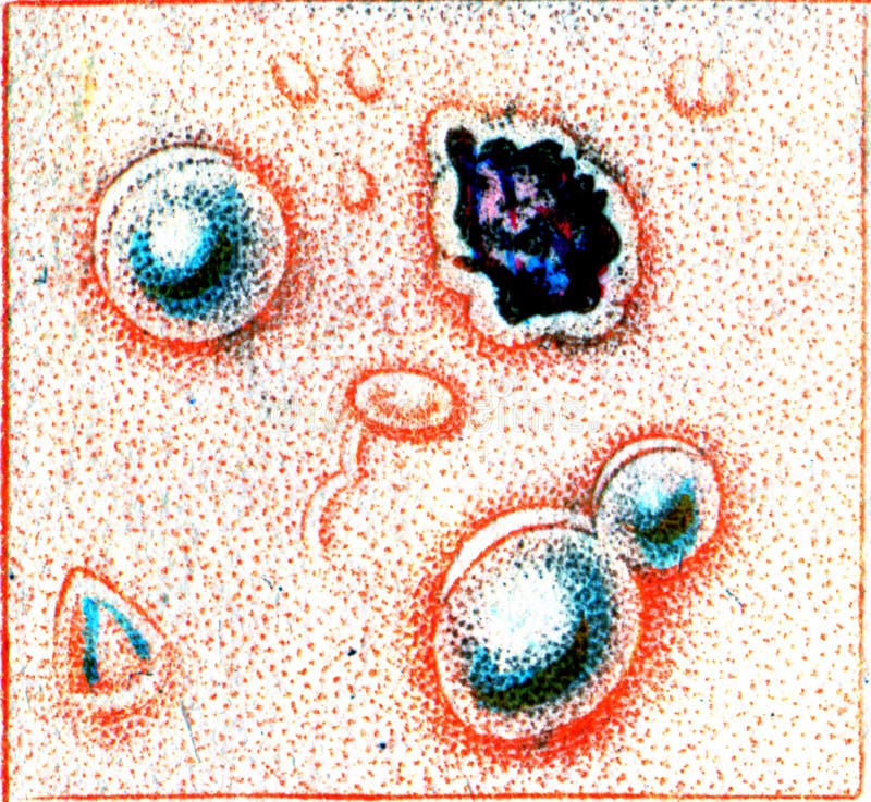 Pustules of Scabies, Vintage Engraving Stock Illustration ...